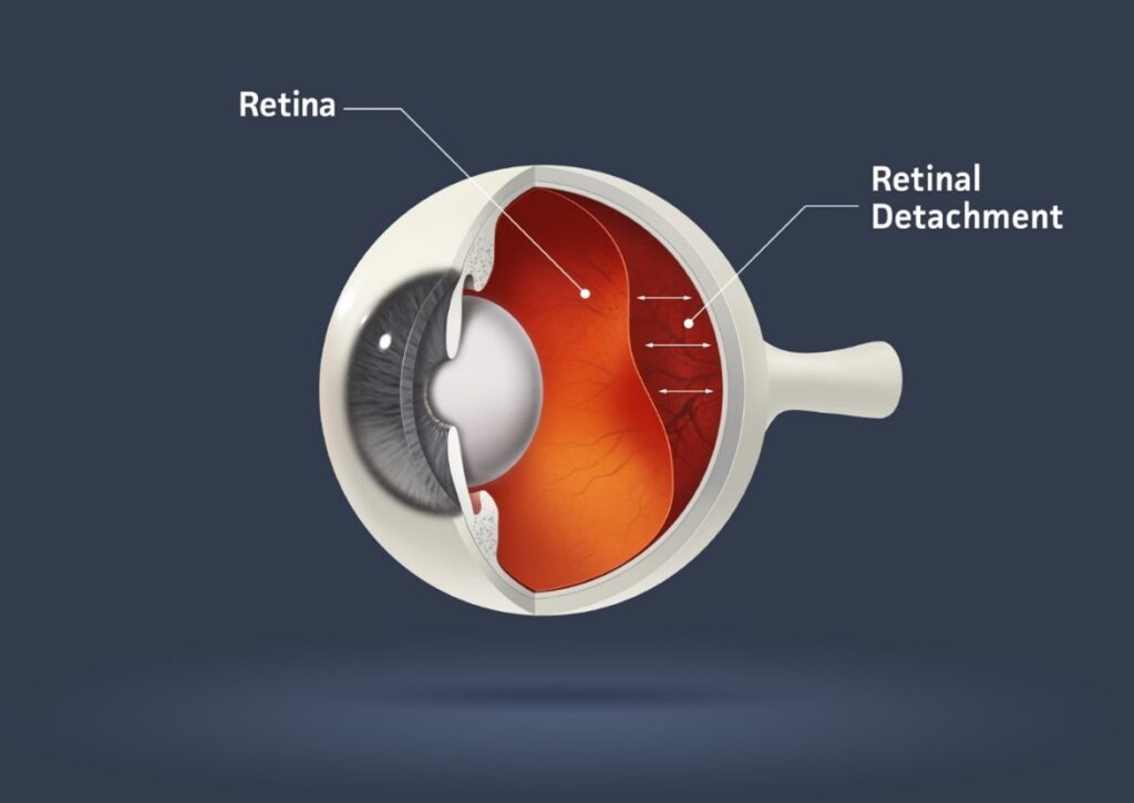 Understanding Retinal Detachment: Causes, Symptoms, Diagnosis, and ...